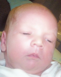 Hutchinson-Gilford Progeria Syndrome (Hgps)