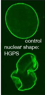 Hutchinson-Gilford Progeria Syndrome (Hgps)