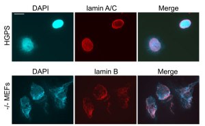 Hutchinson-Gilford Progeria Syndrome (Hgps)