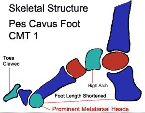 Charcot-Marie-Tooth Disease